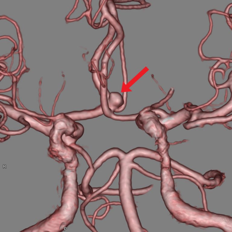 脳血管3DCTA（脳動脈瘤）1のコピー | 医療法人泰庸会 新潟脳外科病院